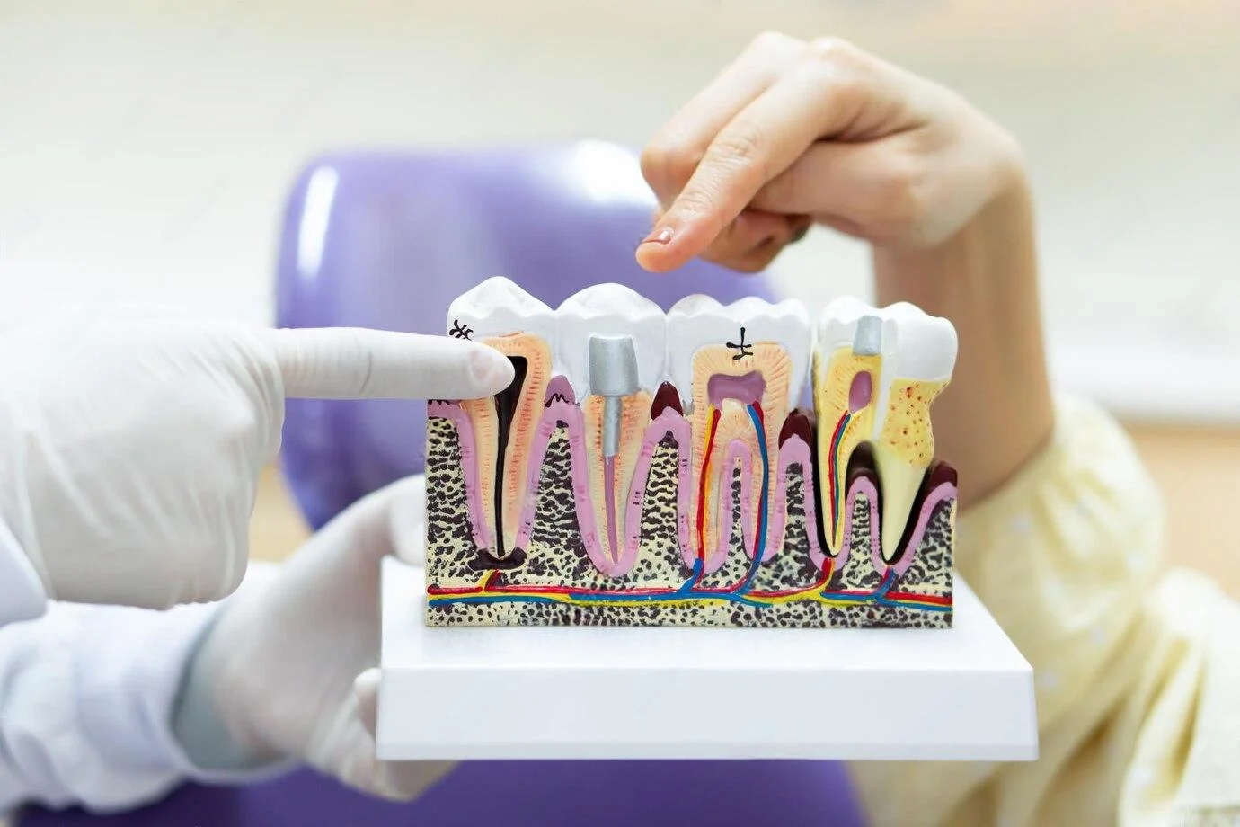 Root Canal Treatment Side Effects Explained - Tweeple Search